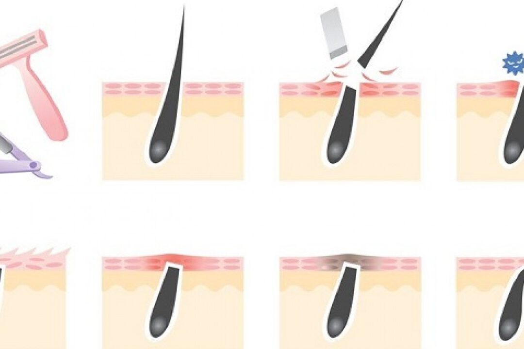 ᐈ quitar pelo enquistado [ 2026 ] Revista Antidoto